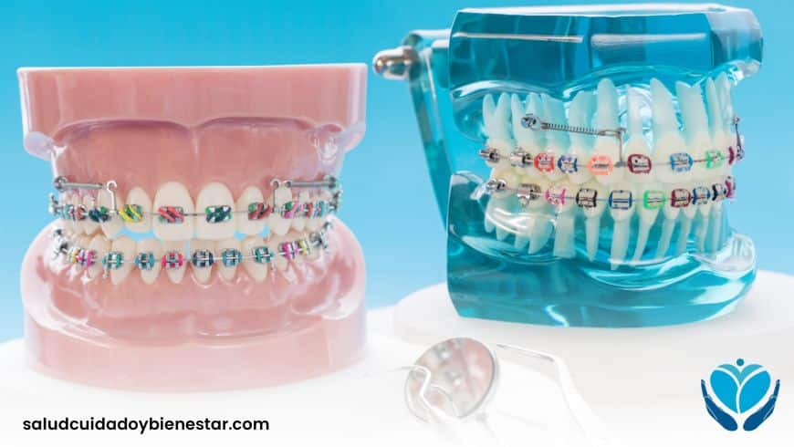 Tipos de Brackets ¿Qué debes saber antes de elegir tu tratamiento de ...